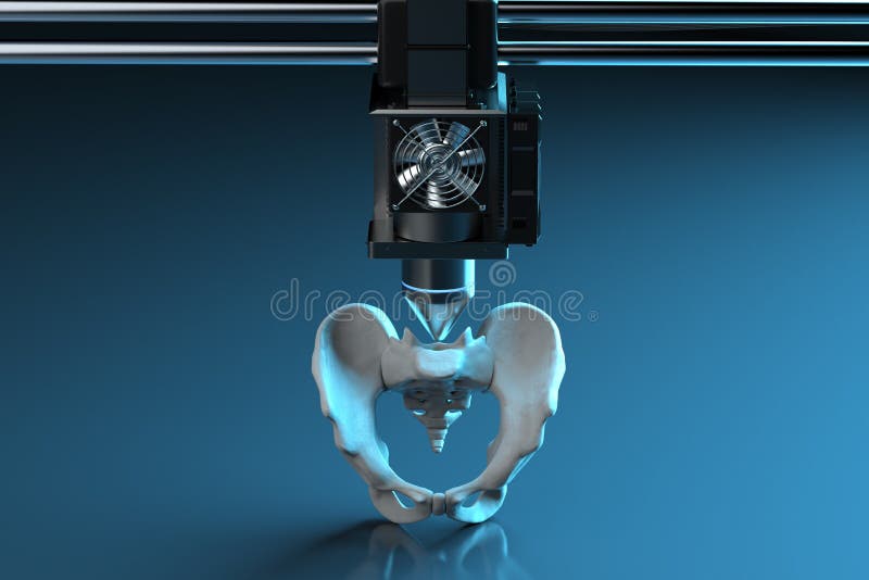 3d Printer Print Prosthetic Spine Stock Illustration - Illustration of ...