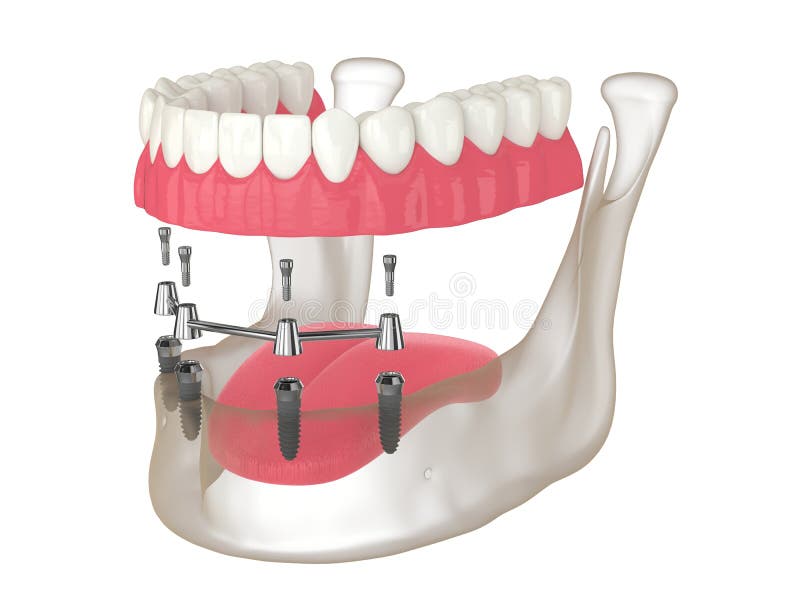 3d Render of Bar Retained Removable Overdenture Installation Supported ...