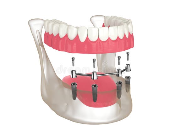 3d Render of Bar Retained Removable Overdenture Installation Supported ...