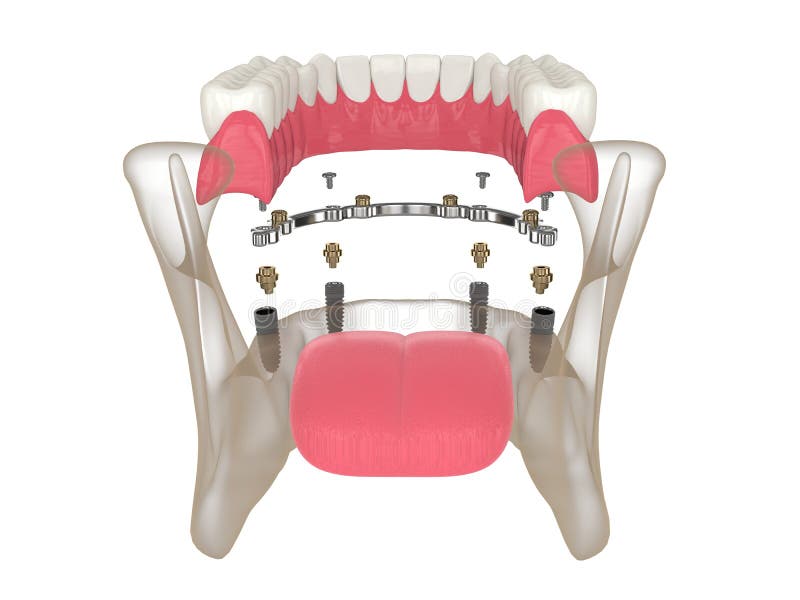 3d Render of Bar Retained Removable Overdenture Installation Supported ...