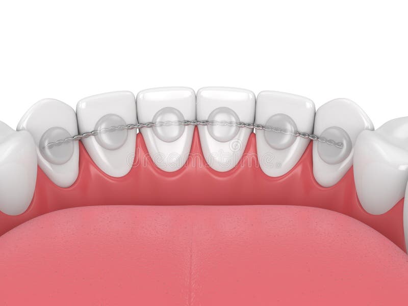 3d Render of Dental Bonded Retainer on Lower Jaw Stock Illustration ...