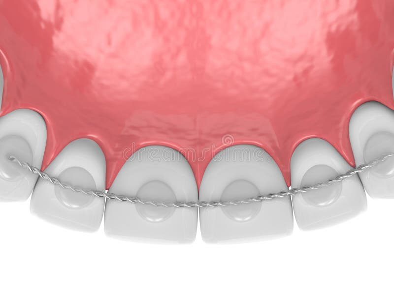 3d Render of Dental Bonded Retainer on Upper Jaw Stock Illustration ...