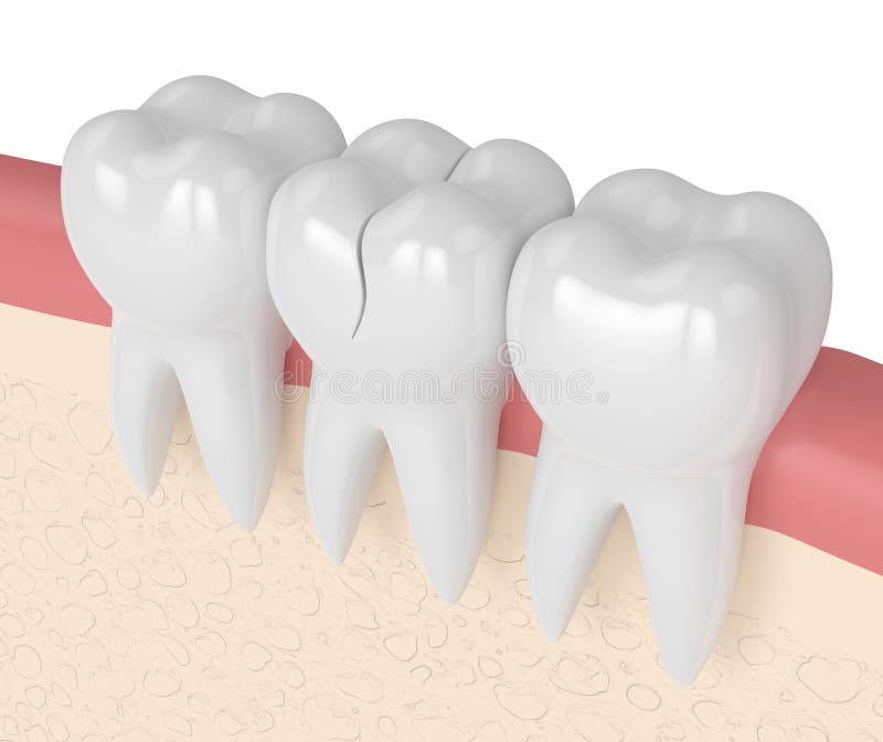 3d Render of Gums with Treatable Cracked Tooth Stock Illustration ...