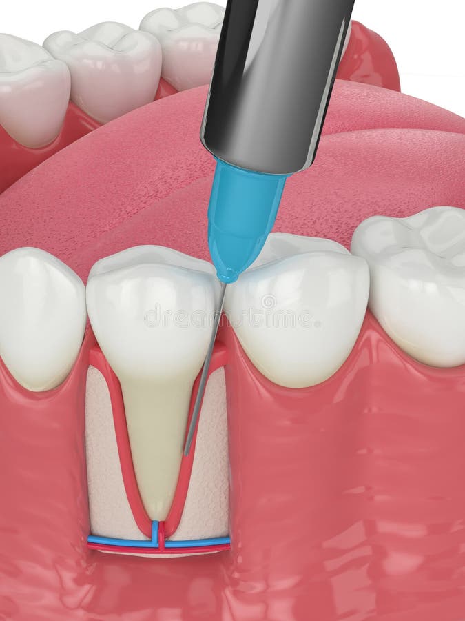3d Render of Human Jaw with Intraligamentary Anesthesia Procedure Stock ...