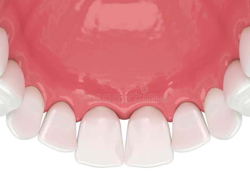 3d Render of Human Upper Jaw with Black Triangles Stock Illustration ...