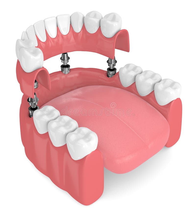 Complete Denture Stock Illustrations – 129 Complete Denture Stock ...