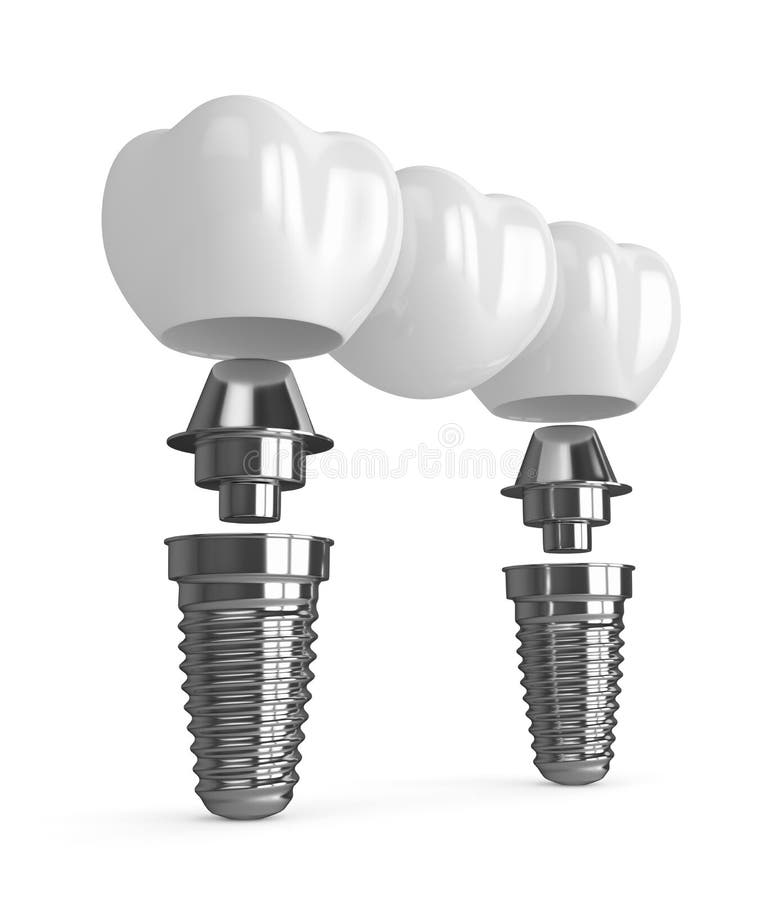 3d Render of Implants Supported Dental Bridge Stock Illustration ...