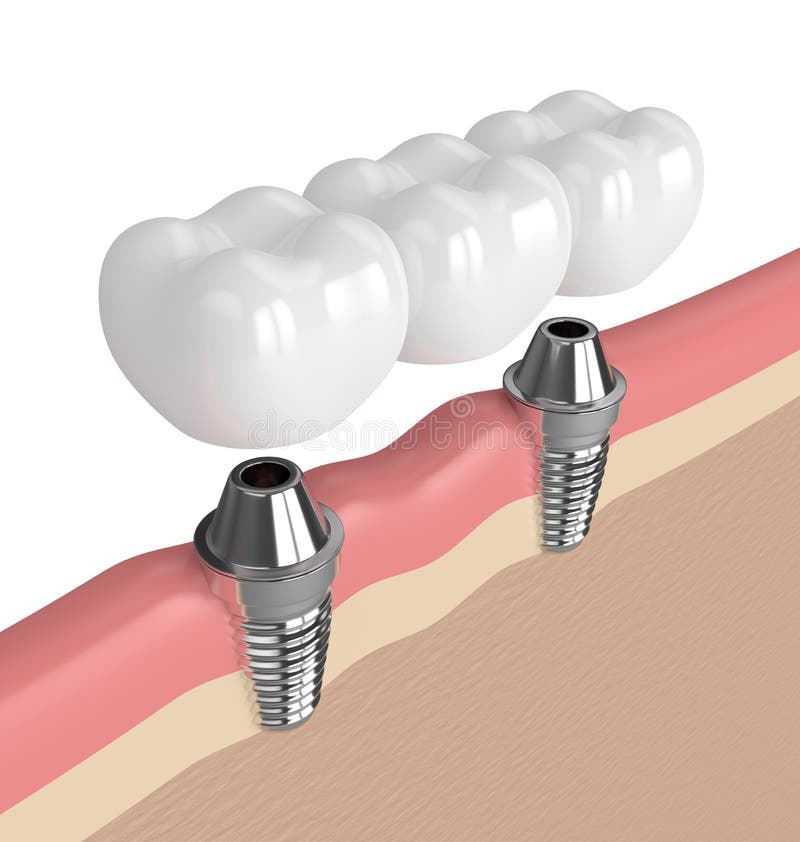 Dental Bridge Stock Illustrations – 1,955 Dental Bridge Stock ...