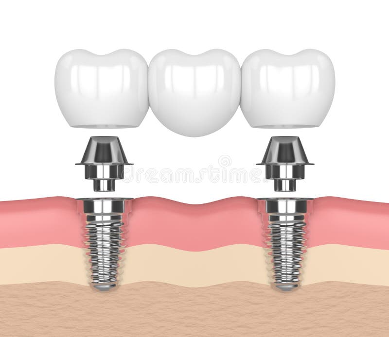 3d Render of Implants with Dental Bridge Stock Illustration ...