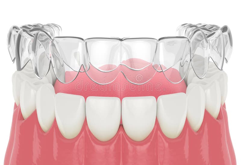 3d Render of Jaw with Invisalign Removable Retainer Stock Illustration ...