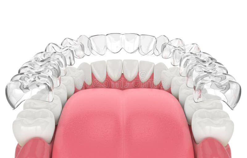 3d Render of Jaw with Invisalign Removable Retainer Stock Illustration ...