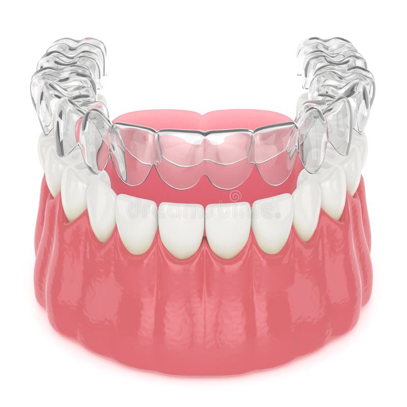 3d Render of Jaw with Invisalign Removable Retainer Stock Illustration ...