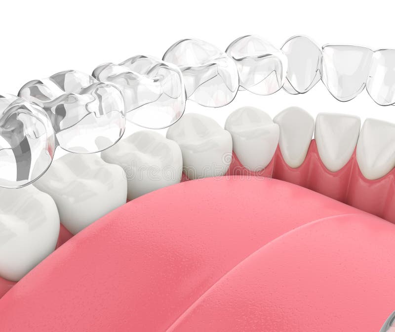 3d Render of Invisalign Removable Retainer with Lower Jaw Stock ...