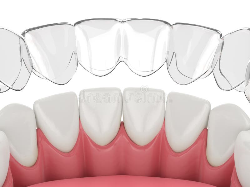 3d Render of Jaw with Invisalign Removable Retainer Stock Illustration ...