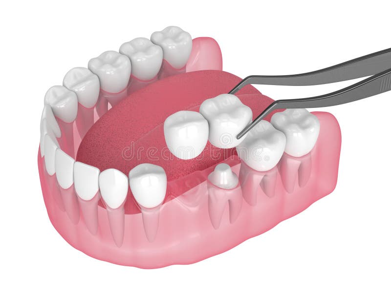 Embedded Tooth Stock Illustrations – 34 Embedded Tooth Stock ...