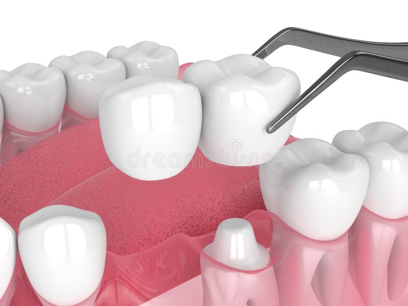 Embedded Tooth Stock Illustrations – 17 Embedded Tooth Stock ...