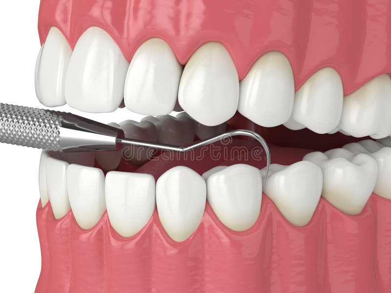 3d Render of Jaw with Dental Explorer Stock Illustration - Illustration ...
