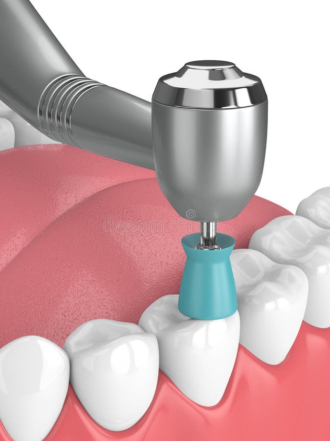 3d Render of Jaw with Dental Handpiece and Polishing Prophy Cup Stock ...