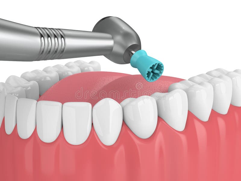 3d Render of Jaw with Dental Handpiece and Polishing Prophy Cup Stock ...