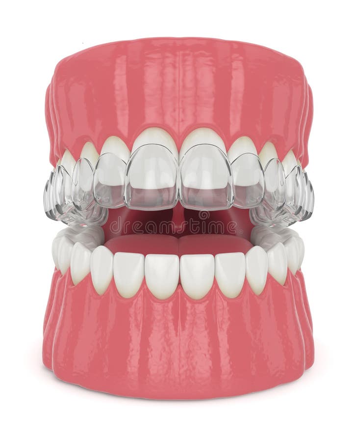3d Render of Jaw with Invisalign Removable Retainer Stock Illustration ...
