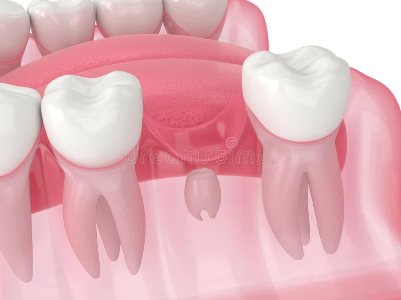 3d Render of Jaw with New Tooth Growing between Two Teeth Stock ...