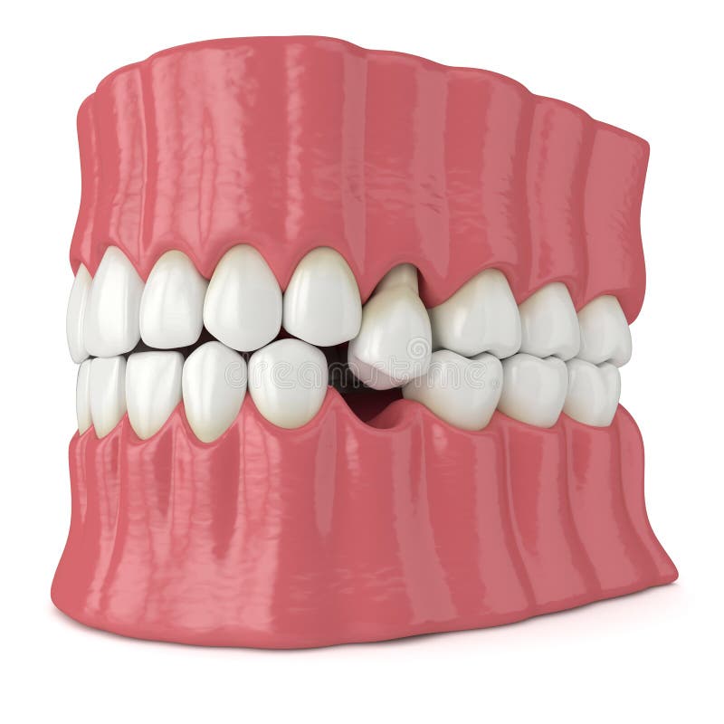 3d Render of Tooth with Endodontic File Stock Illustration ...