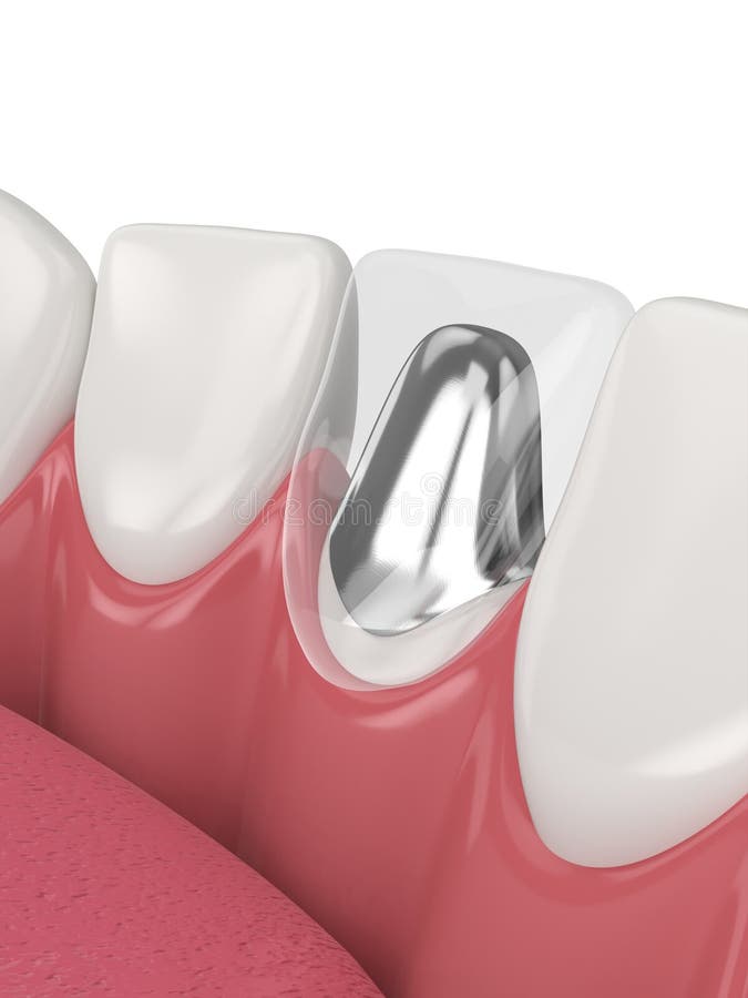 3d Render of Lower Jaw with Cast Post and Core Tooth Restoration Stock ...
