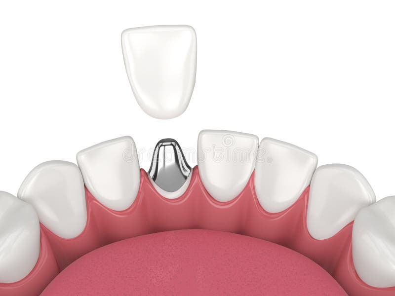 3d Render of Lower Jaw with Cast Post and Core Tooth Restoration Stock ...