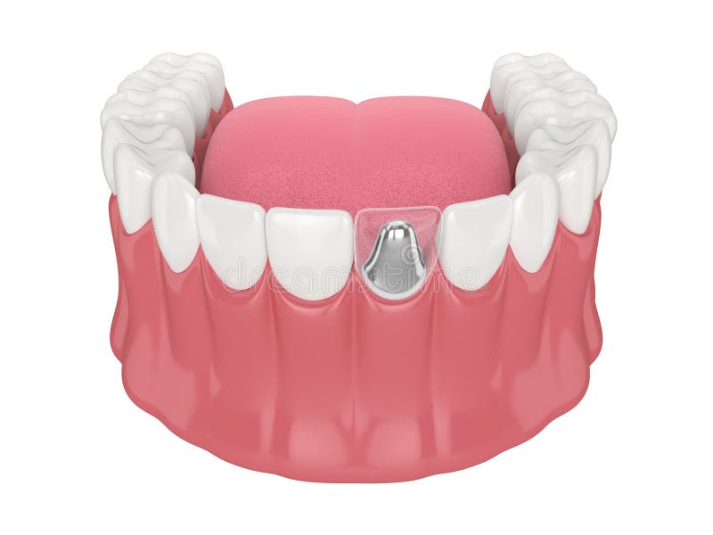 3d Render of Lower Jaw with Cast Post and Core Tooth Restoration Stock ...