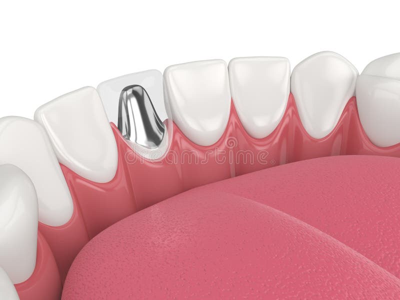 3d Render of Lower Jaw with Cast Post and Core Tooth Restoration Stock ...