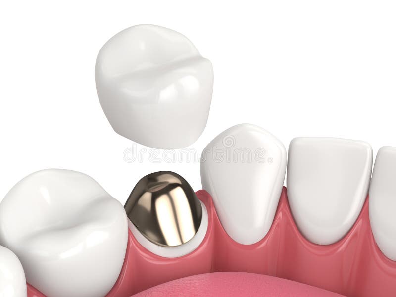 3d Render of Lower Jaw with Cast Post and Core Tooth Restoration Stock ...