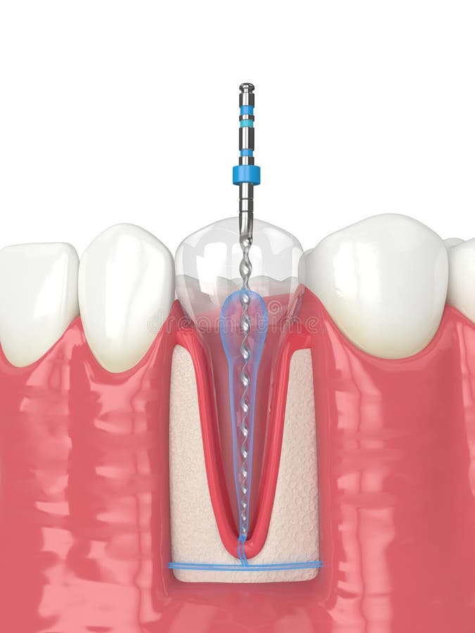 Endodontic File Stock Illustrations – 81 Endodontic File Stock ...
