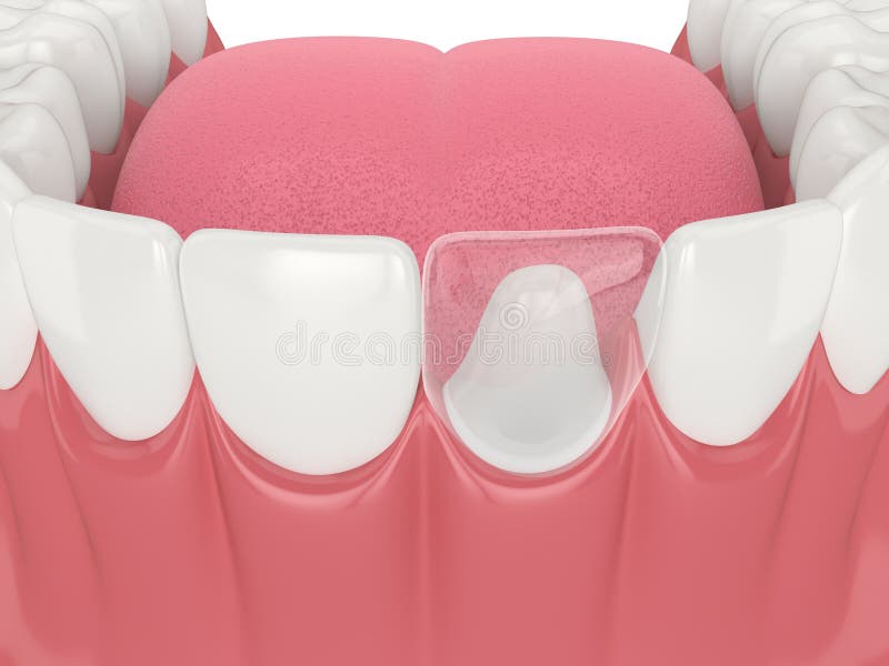3d Render of Lower Jaw with Post and Core Tooth Restoration Stock ...