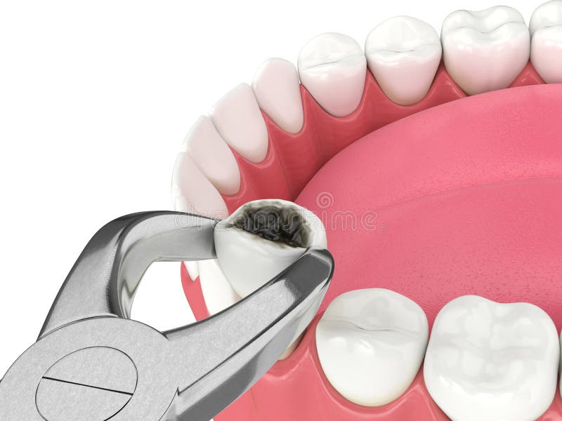 3d Render of Lower Jaw with Tooth Extraction Stock Illustration ...