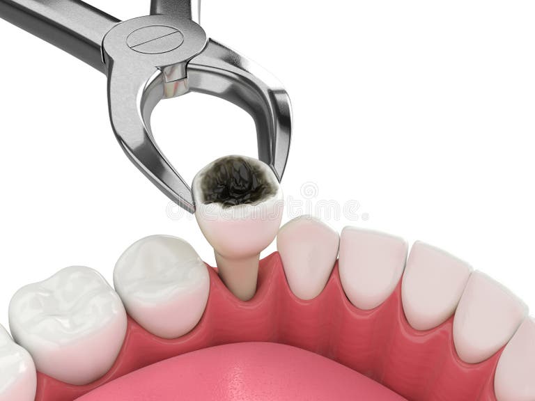 Extraction Instrument Stock Illustrations – 1,860 Extraction Instrument ...