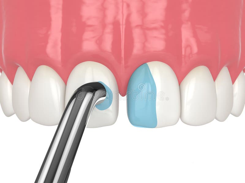 Diastema Closure Stock Illustrations – 19 Diastema Closure Stock ...