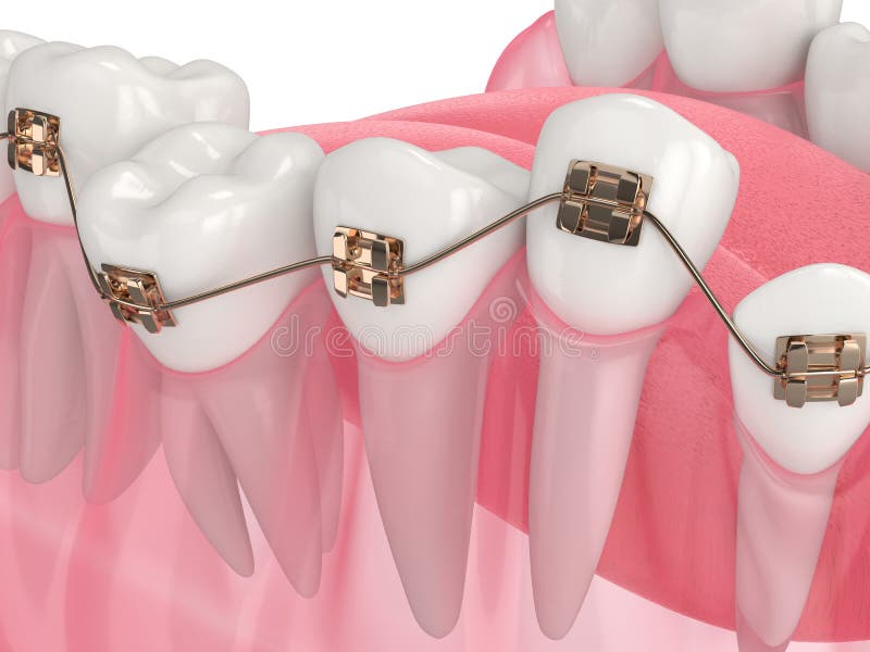 3d Render of Teeth Alignment by Orthodontic Braces Stock Illustration ...