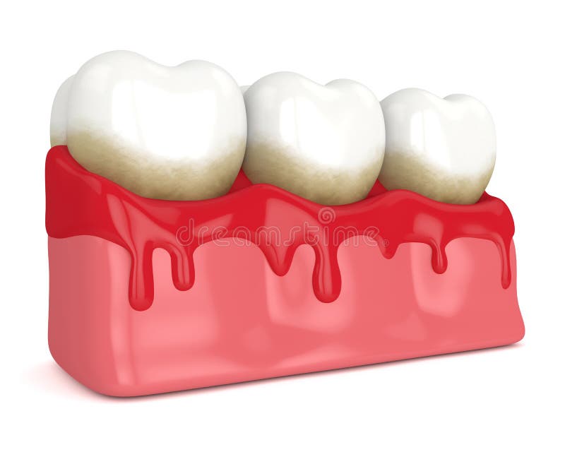 Swollen Gums Stock Illustrations – 70 Swollen Gums Stock Illustrations ...