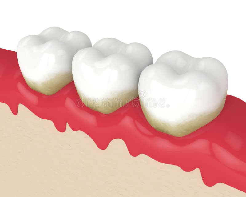 Bleeding Gums and Gum Disease. Stock Illustration - Illustration of ...