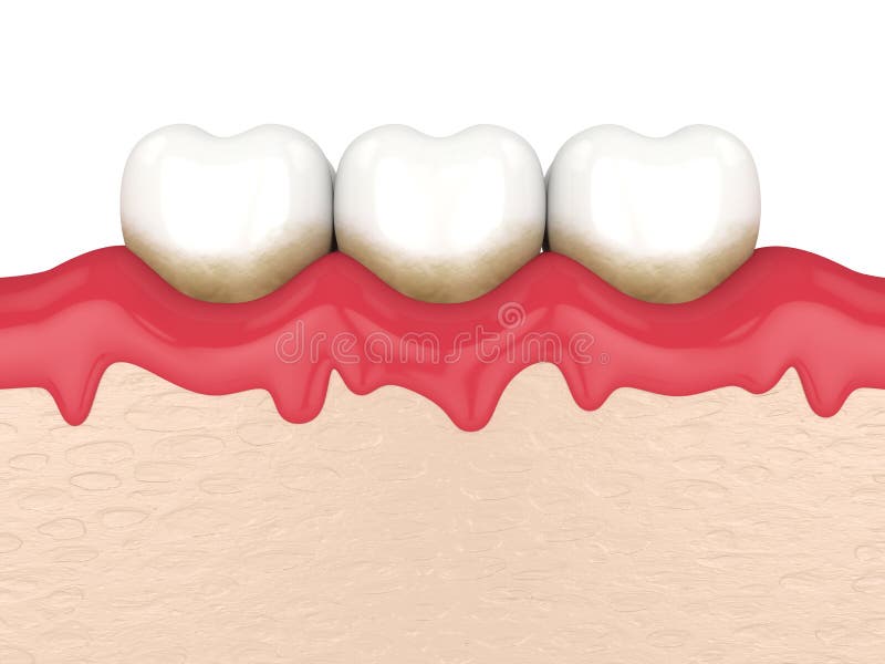 Bleeding Gums Color Icon Vector Illustration Stock Illustration ...