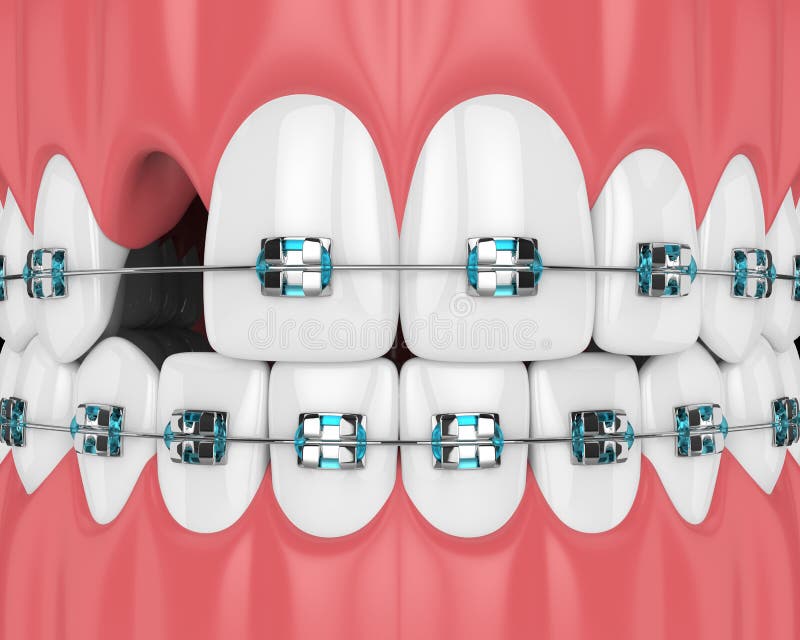 3d Render of Teeth with Braces and Cavity Stock Illustration ...