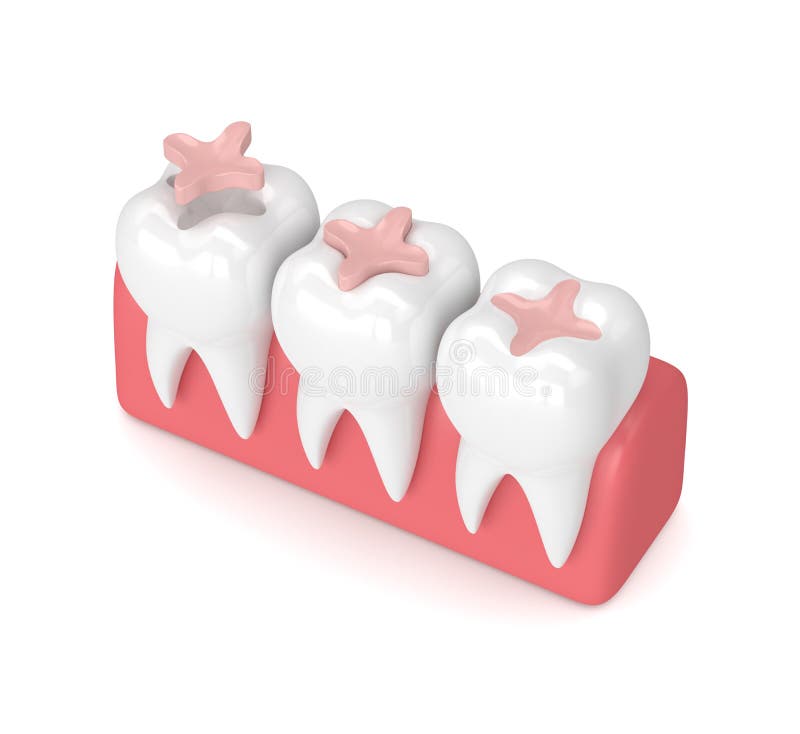 Inlay Onlay Overlay Stock Illustrations – 274 Inlay Onlay Overlay Stock ...