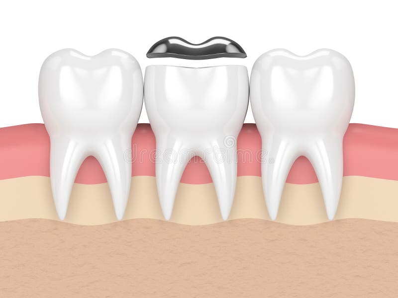 3d Render of Teeth with Dental Onlay Amalgam Filling Stock Illustration ...