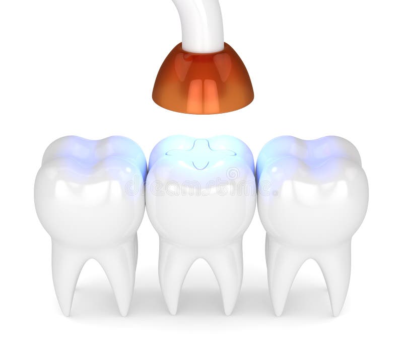 3d Render of Teeth with Dental Polymerization Lamp and Light Cured ...