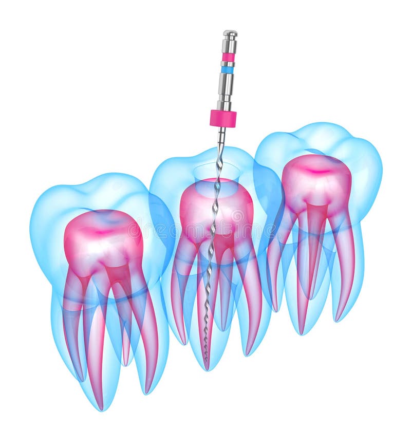 3d Render of Teeth with Endodontic File Over White Background Stock ...