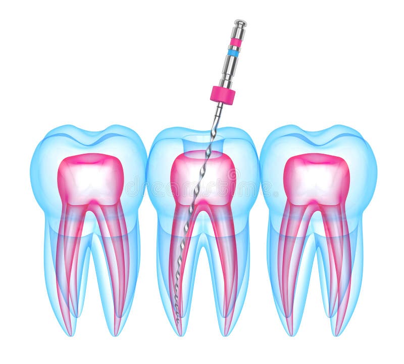 3d Render of Teeth with Endodontic File Over White Background Stock ...
