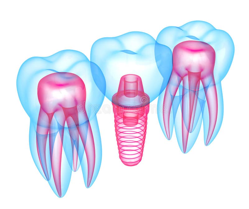 3d Render of Teeth with Fiber Post Over White Stock Illustration ...