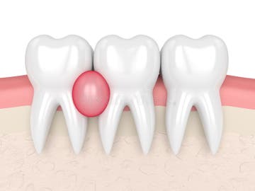 Periapical Abscess Stock Illustrations – 13 Periapical Abscess Stock ...