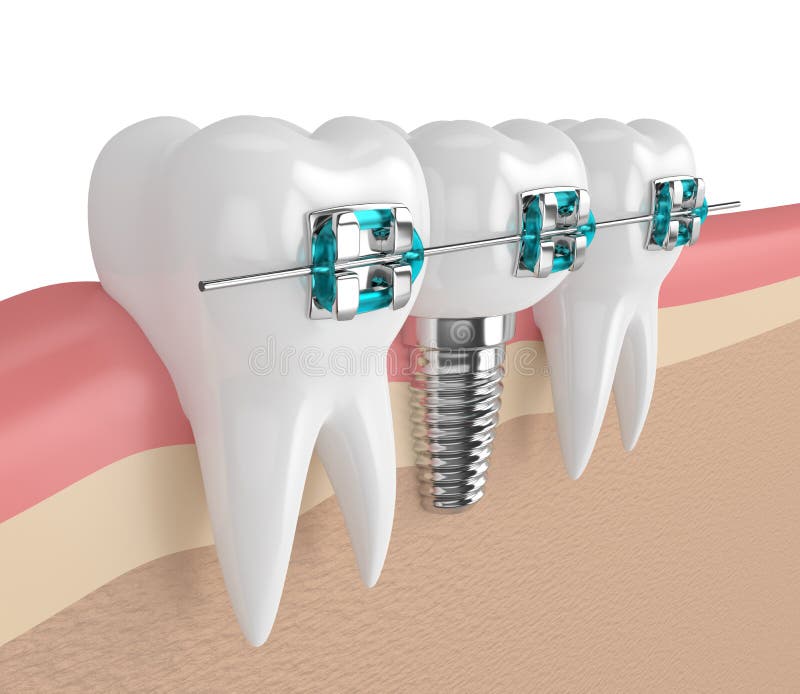 3d Render of Teeth with Implant and Braces Stock Illustration ...