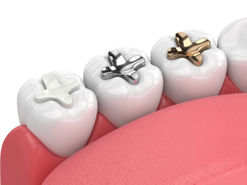 3d Render of Teeth with Inlay Stock Illustration - Illustration of ...
